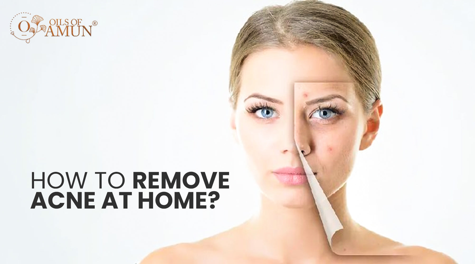 How To Remove Acne at Home?